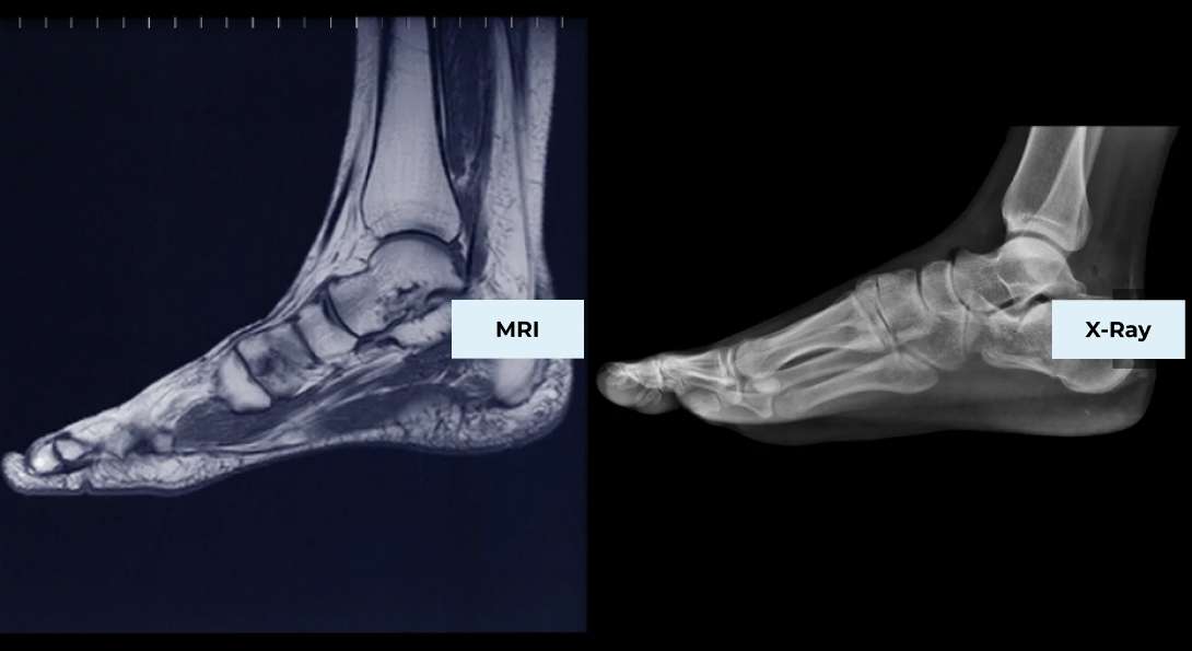 Lower Extremity MRI: Advantages of MRI Over X-rays and Ultrasounds ...